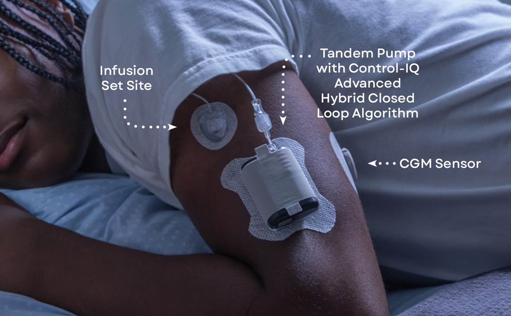 What is an Automated Insulin Delivery System?