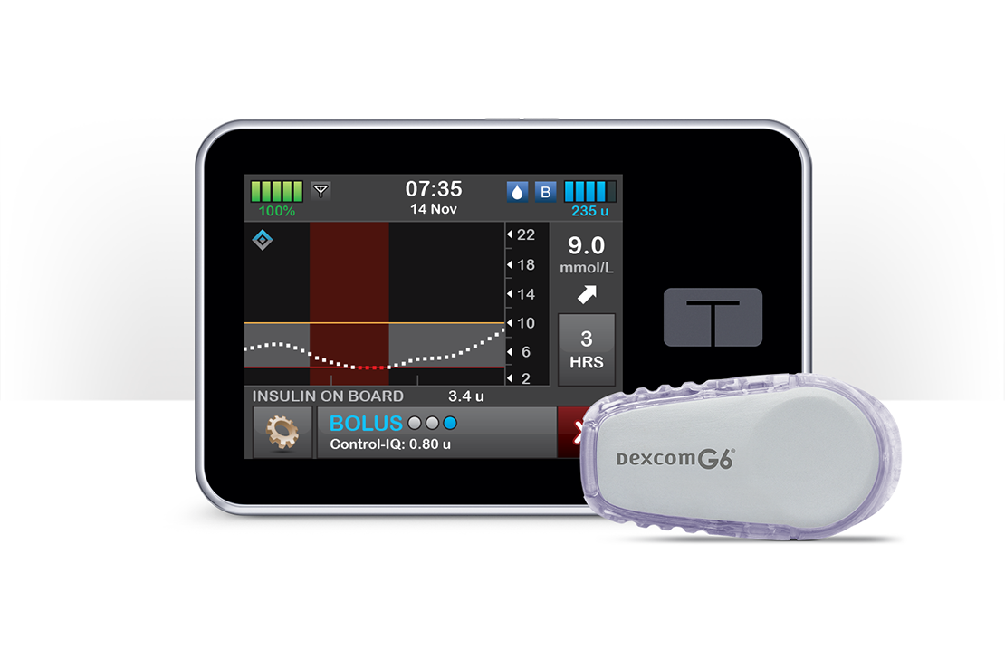 Finally: control iq is coming to germany, Tandem's Latest Breakthroughsㅤ