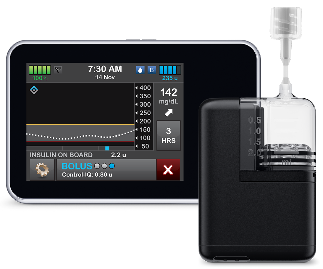 Dexcom CGM & t:slim X2 Insulin Pump | Tandem Diabetes Care